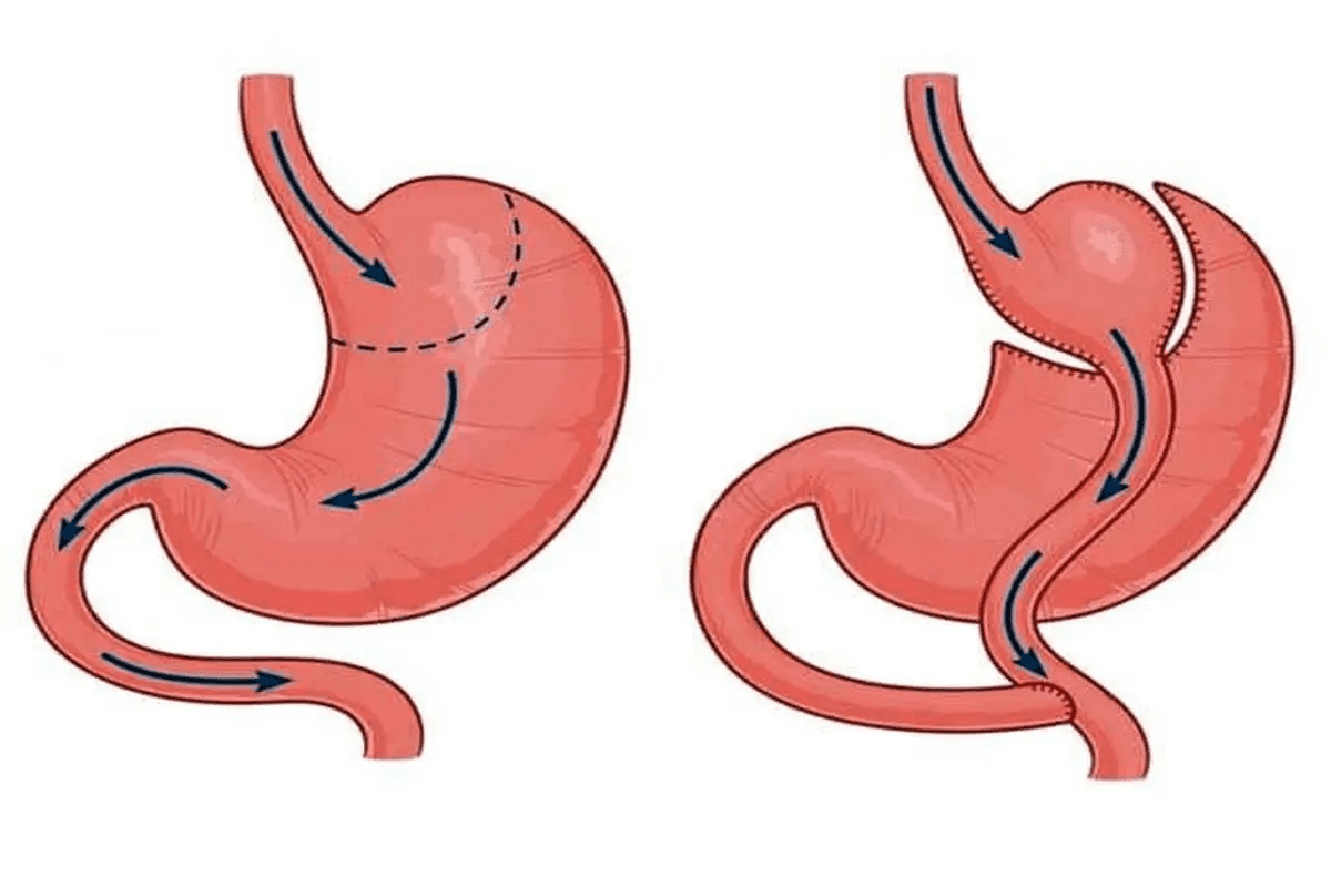 Choosing Between Roux En Y Vs Sleeve - Liv Hospital
