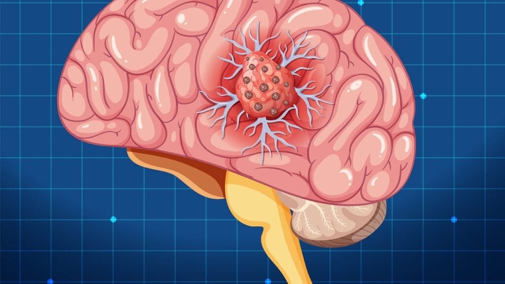 7 Key Facts About Brain Stem Tumor Prognosis & Life Expectancy