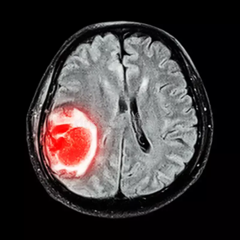 How Curable Are Brain Tumors and What Does 'Inoperable' Mean for Survival?