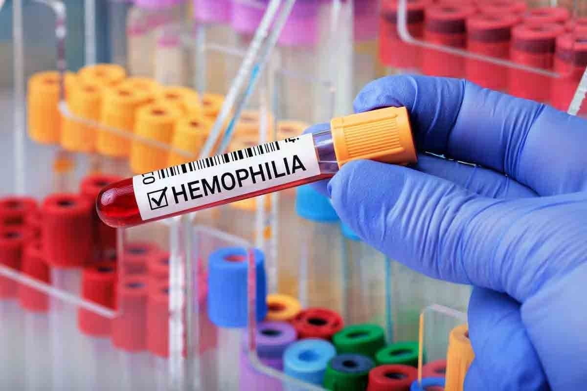 What is the new treatment for hemophilia? - Liv Hospital