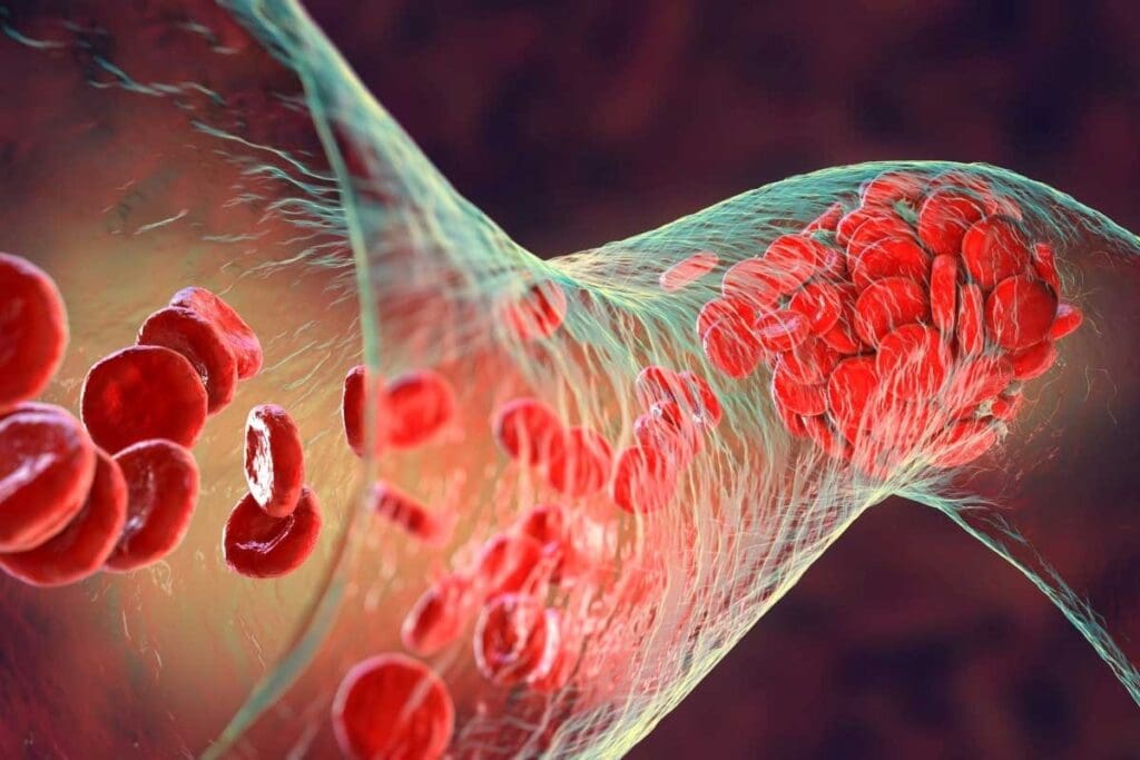 5 Real Signs: What Does DVT Pain Feel Like vs a Pulled Muscle? - Liv ...