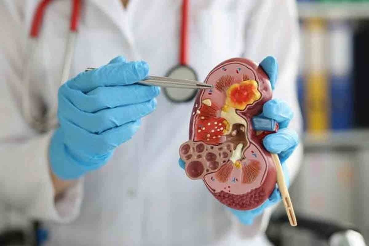 NM Renal Scan: Results & Lasix Protocols - Liv Hospital