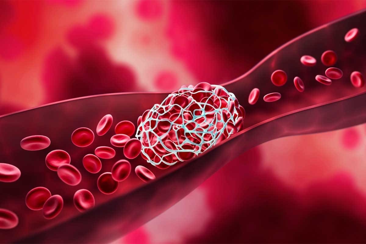 7 Types of Blood Clots Explained: From Hard to Jelly-Like Forms - Liv ...