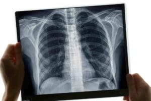 Chest X Ray Dose: 7 Ultimate and Powerful Facts - Liv Hospital