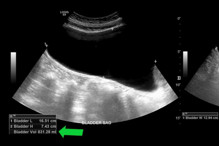 Abnormal PVR: What the PVR Medical Abbreviation Means - Liv Hospital