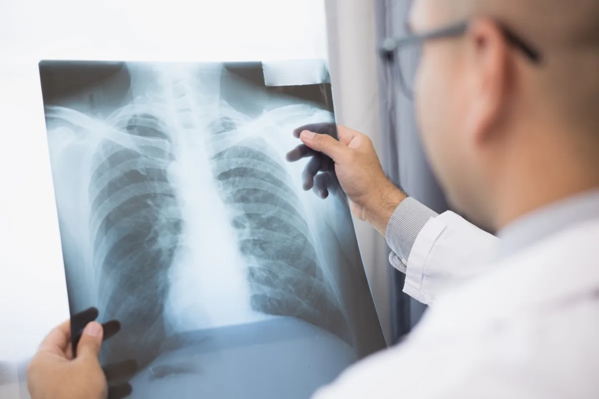 Asthma CXR: 5 Key Findings Explained - Liv Hospital