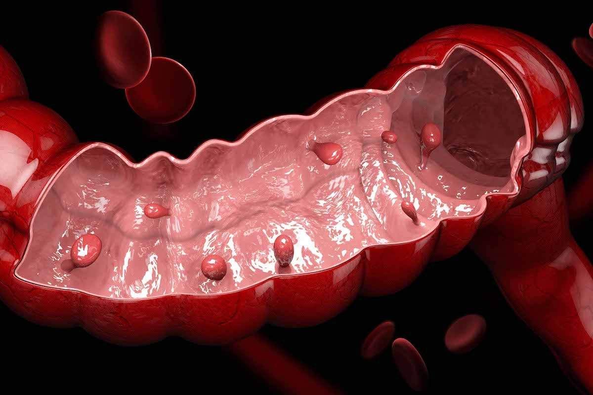 Sigmoid Colon Pain: The Surprising, Critical Causes - Liv Hospital