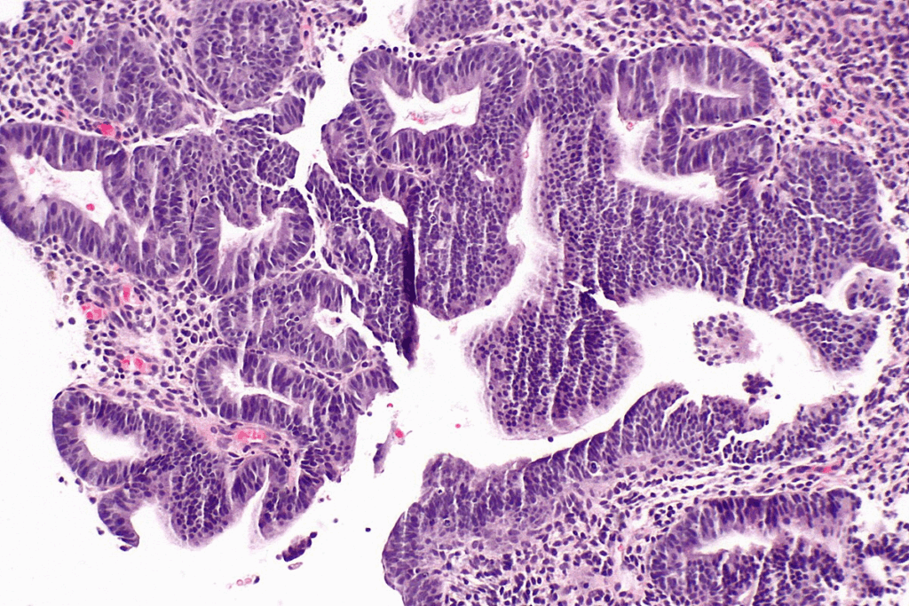 Atypical Hyperplasia Endometrium: Alarming Risk - Liv Hospital