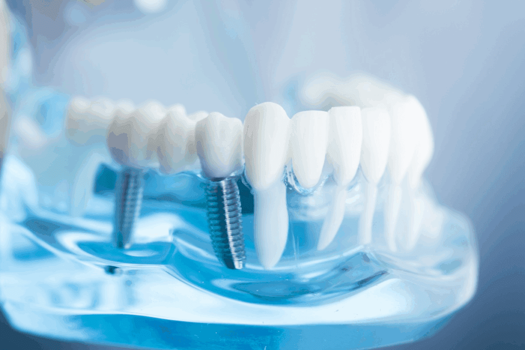 Dental Implant Procedure Steps: Step-by-Step - Liv Hospital