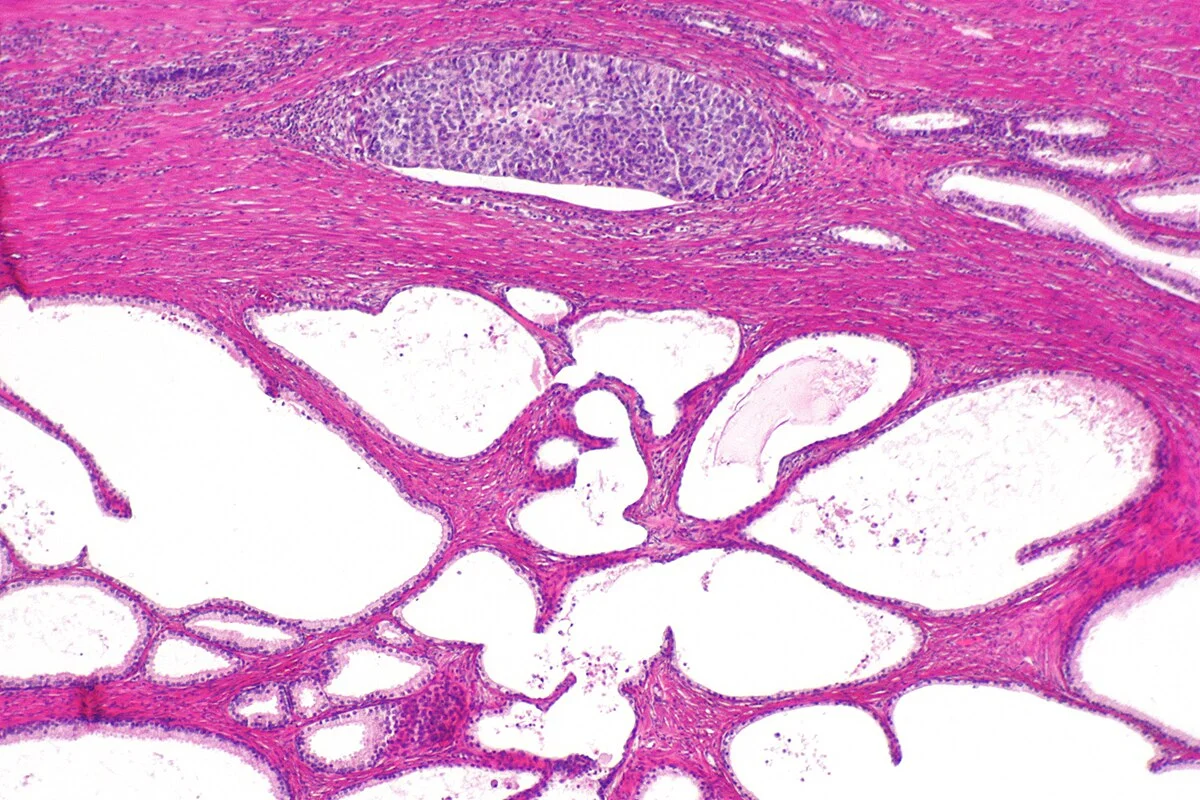 Symptoms and Risk Factors - Liv Hospital