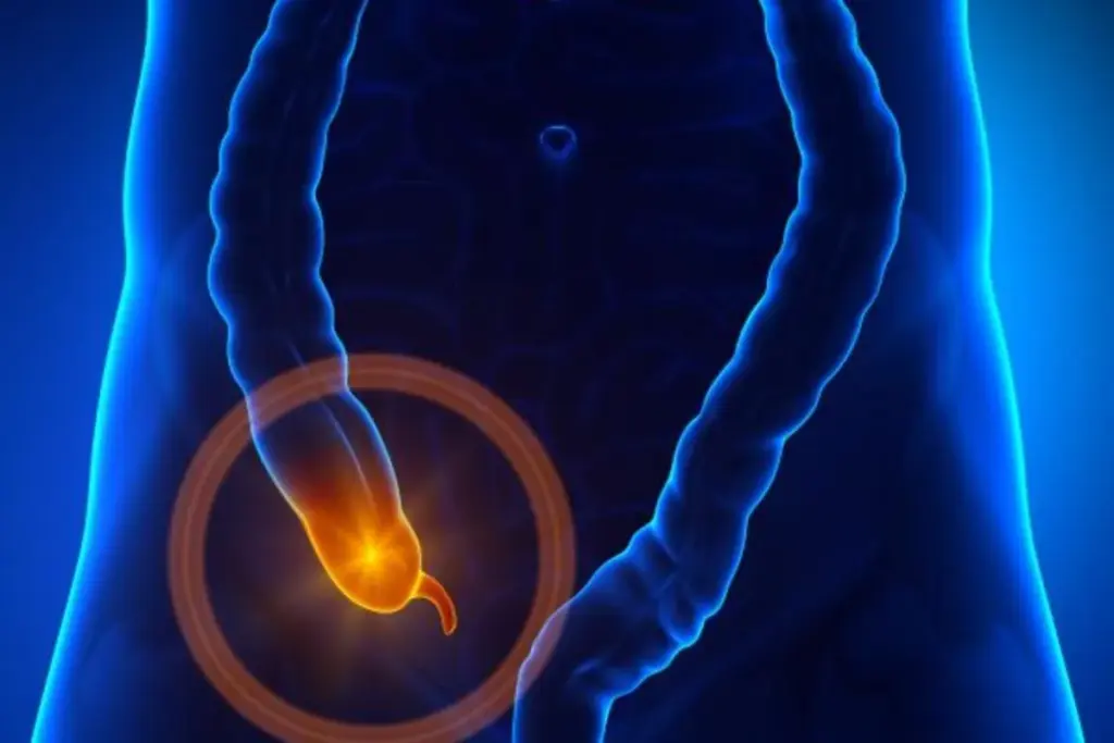 Ruptured Appendicitis Signs And Symptoms Info - Liv Hospital