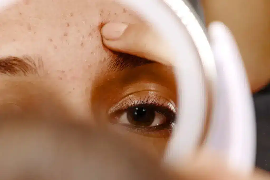 Essential Can Being Run Down Cause Acne (Acne)? - Liv Hospital