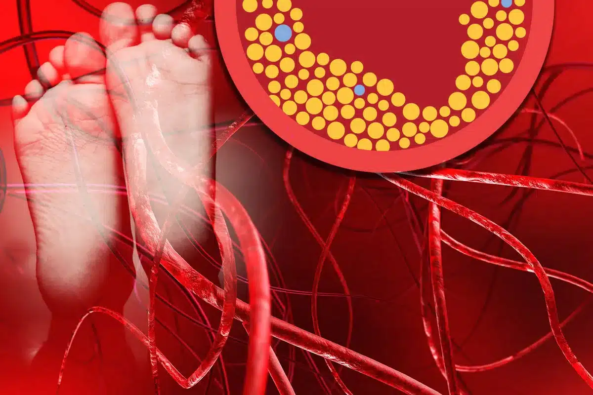 Peripheral Artery Disease Mimicking Conditions - Liv Hospital