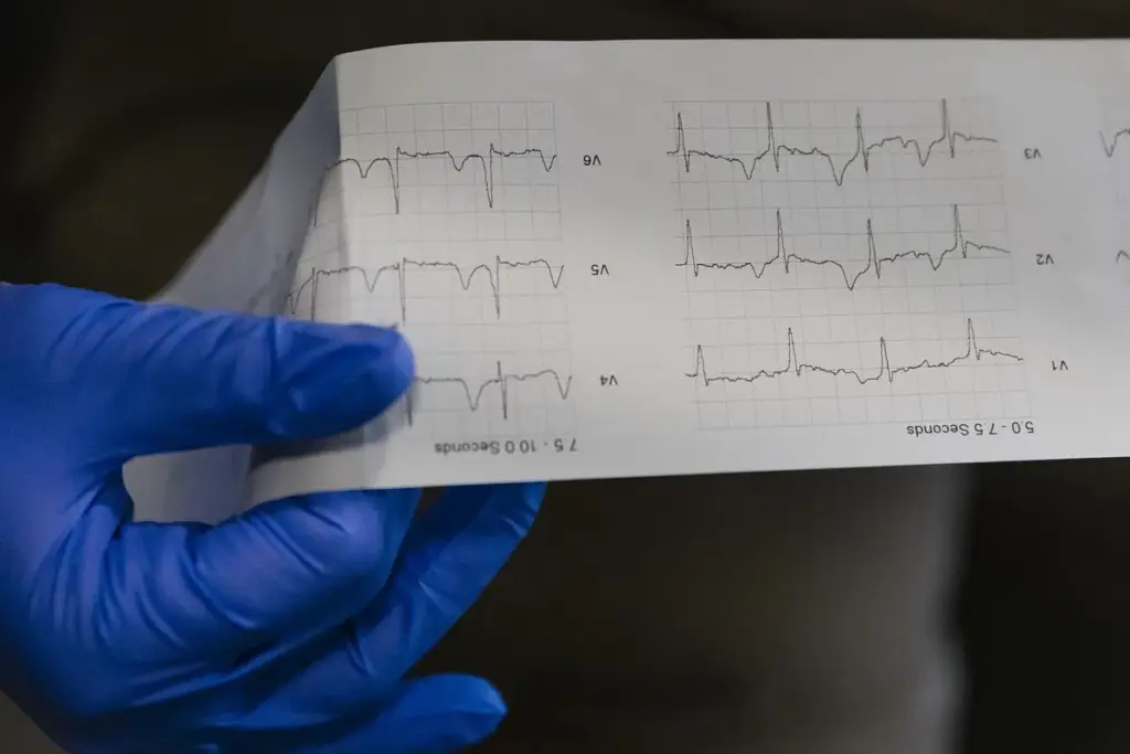 Key Atrial Fibrillation EKG Detection Steps - Liv Hospital
