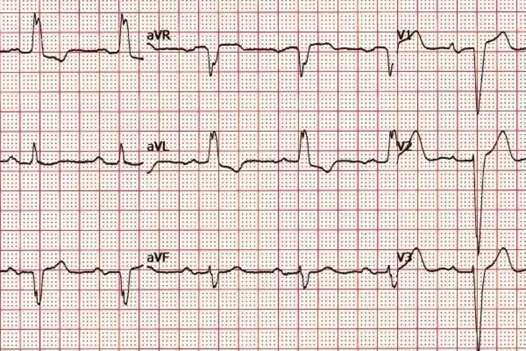 Critical Five Fatal Cardiac Rhythms Revealed - Liv Hospital