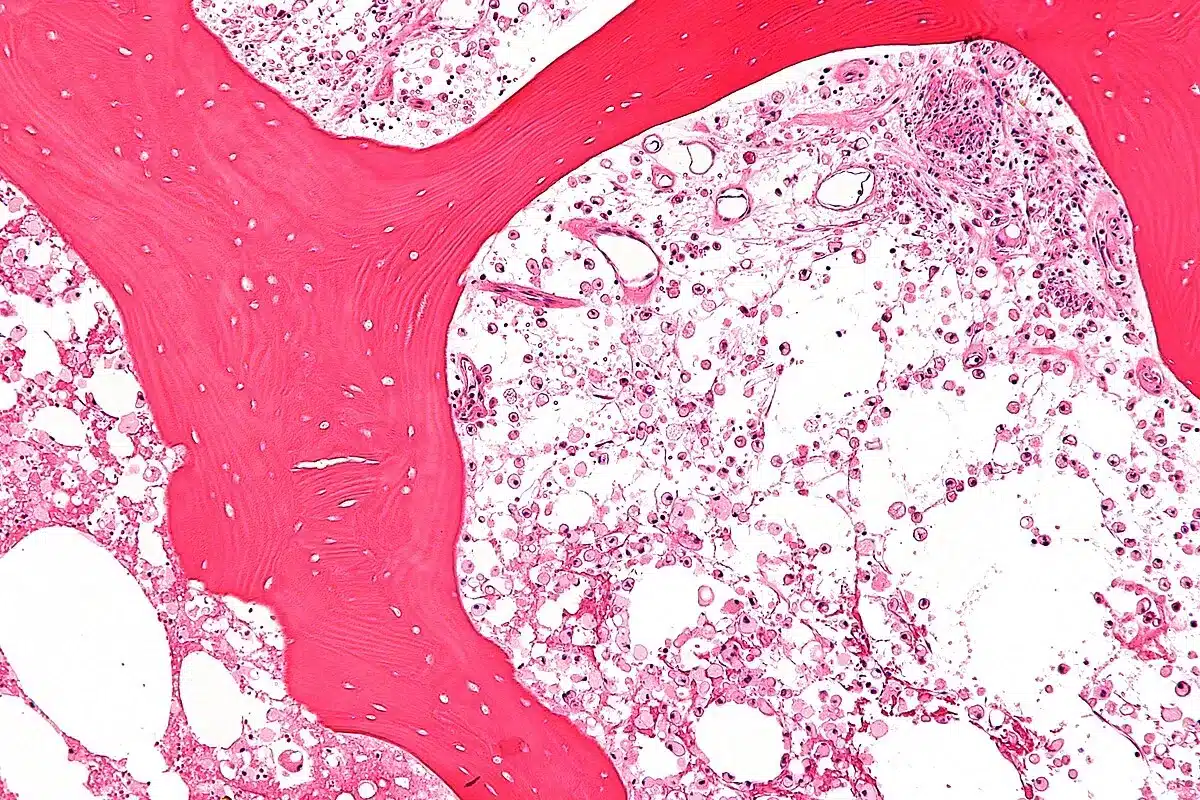 Essential 5 Heart Disease Coronary Heart Disease Symptoms - Liv Hospital