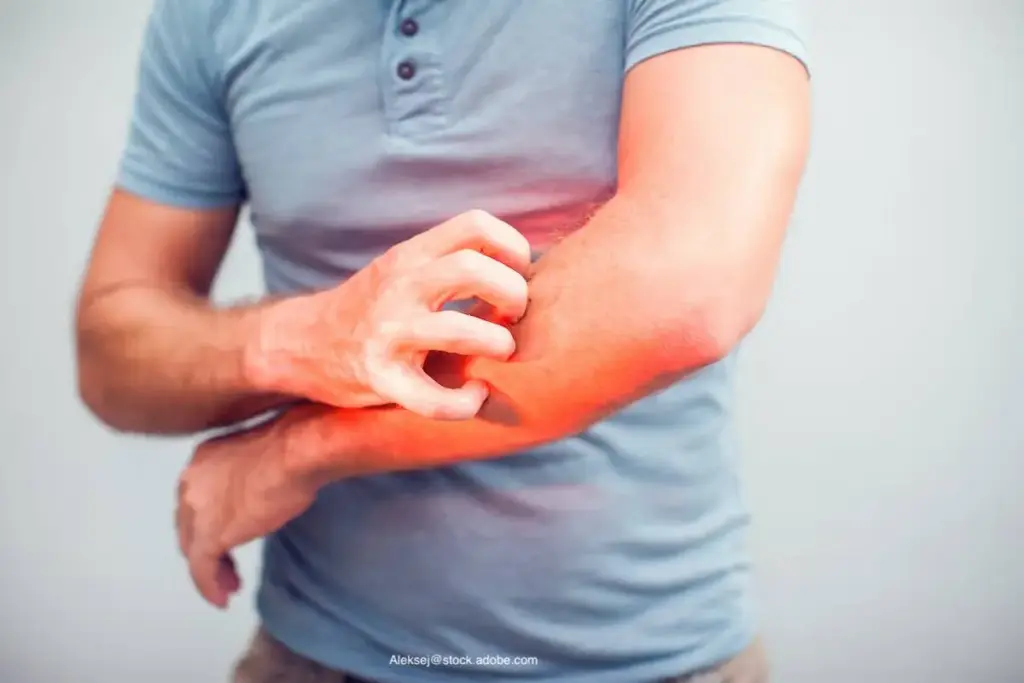 Complete What Is The True Patch Test For Allergies? - Liv Hospital