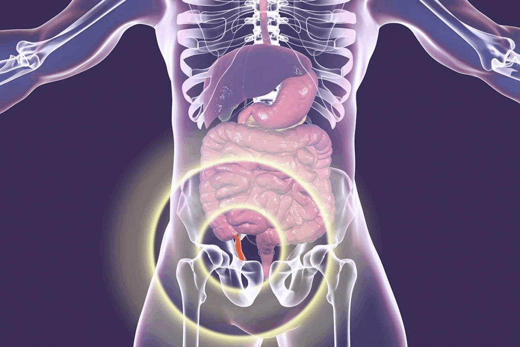 Stages of Appendicitis: 5 Grim Signs - Liv Hospital